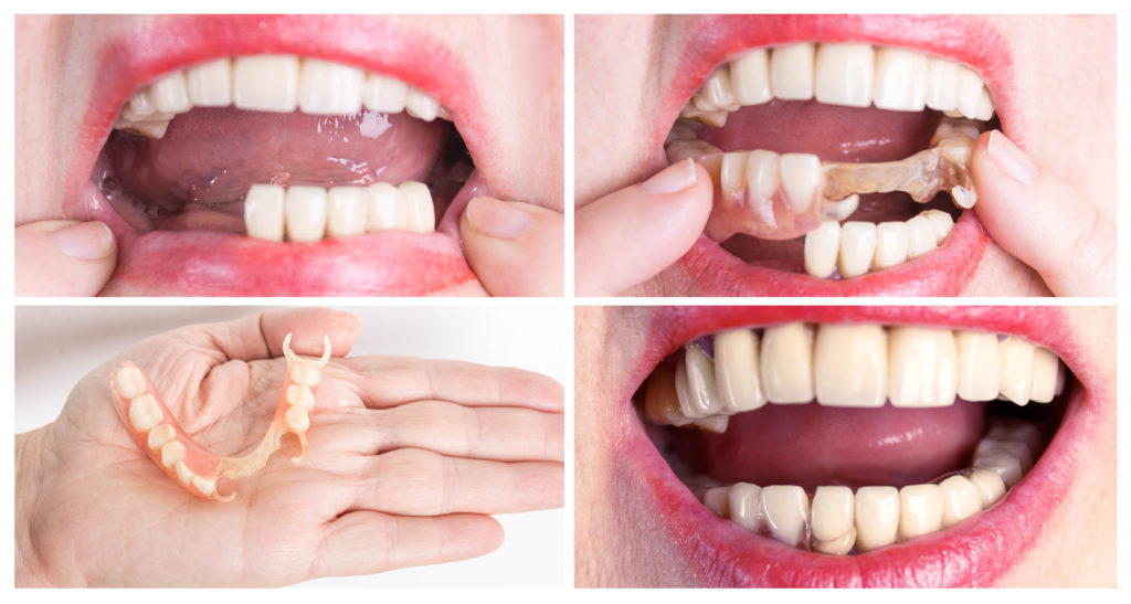 PARTIAL DENTURE RICHMOND FAMILY DENTISTRY